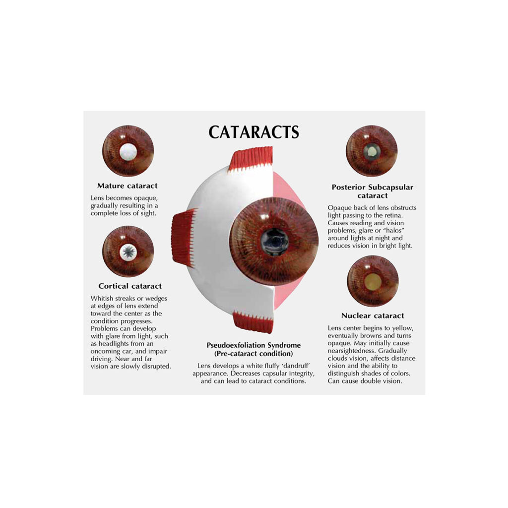 Olho com Catarata | MogiGlass Anatomia e Simulação