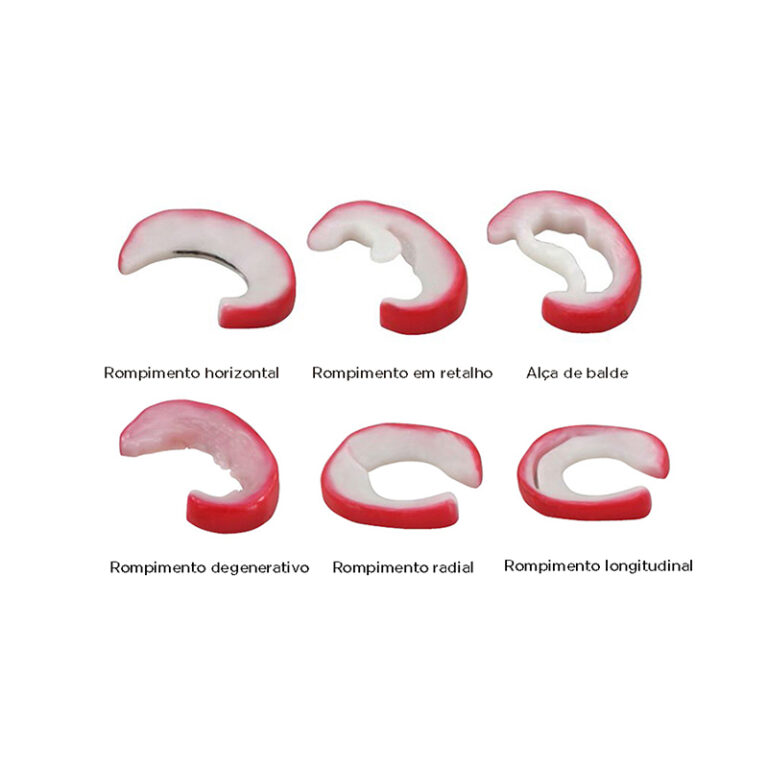 Joelho com 6 Rompimentos de Menisco | MogiGlass Anatomia e Simulação