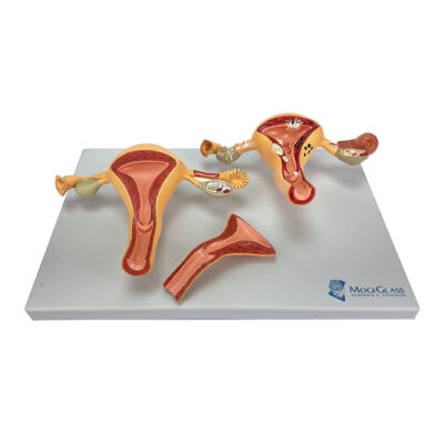 Útero Normal e com Patologia | MogiGlass Anatomia e Simulação